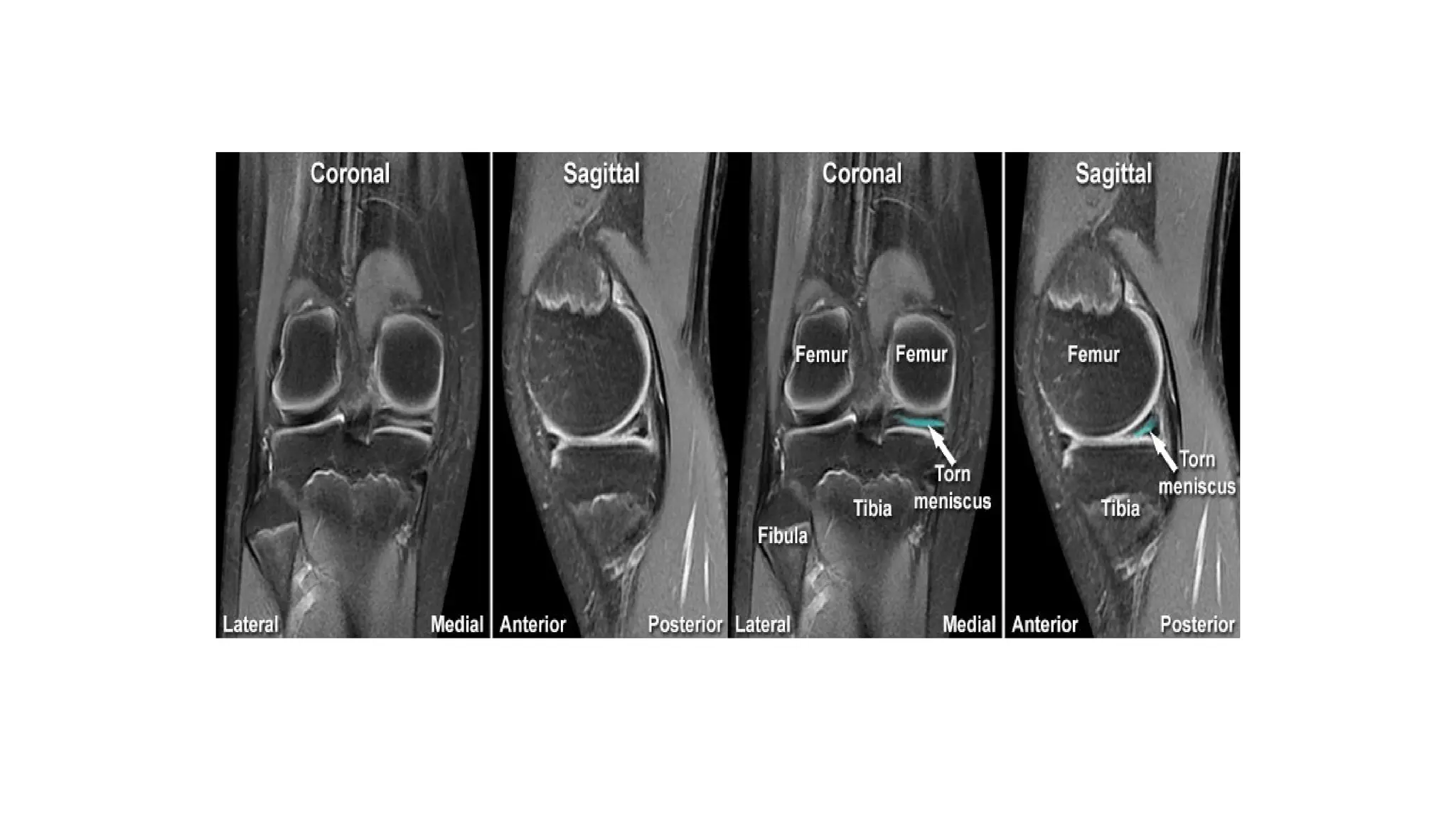 Meniscal Injuries diagnosis investigations and management | PPT