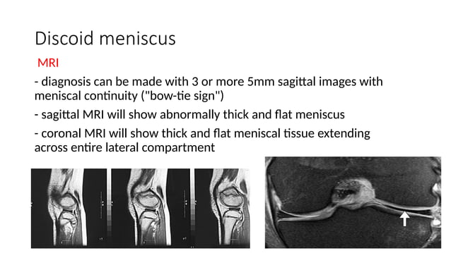 Meniscal injuries & Discoid meniscus (2024).pptx