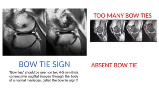 Clinical,Diagnostic and Radiological findings of Meniscal injuries.pptx