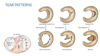 Clinical,Diagnostic and Radiological findings of Meniscal injuries.pptx