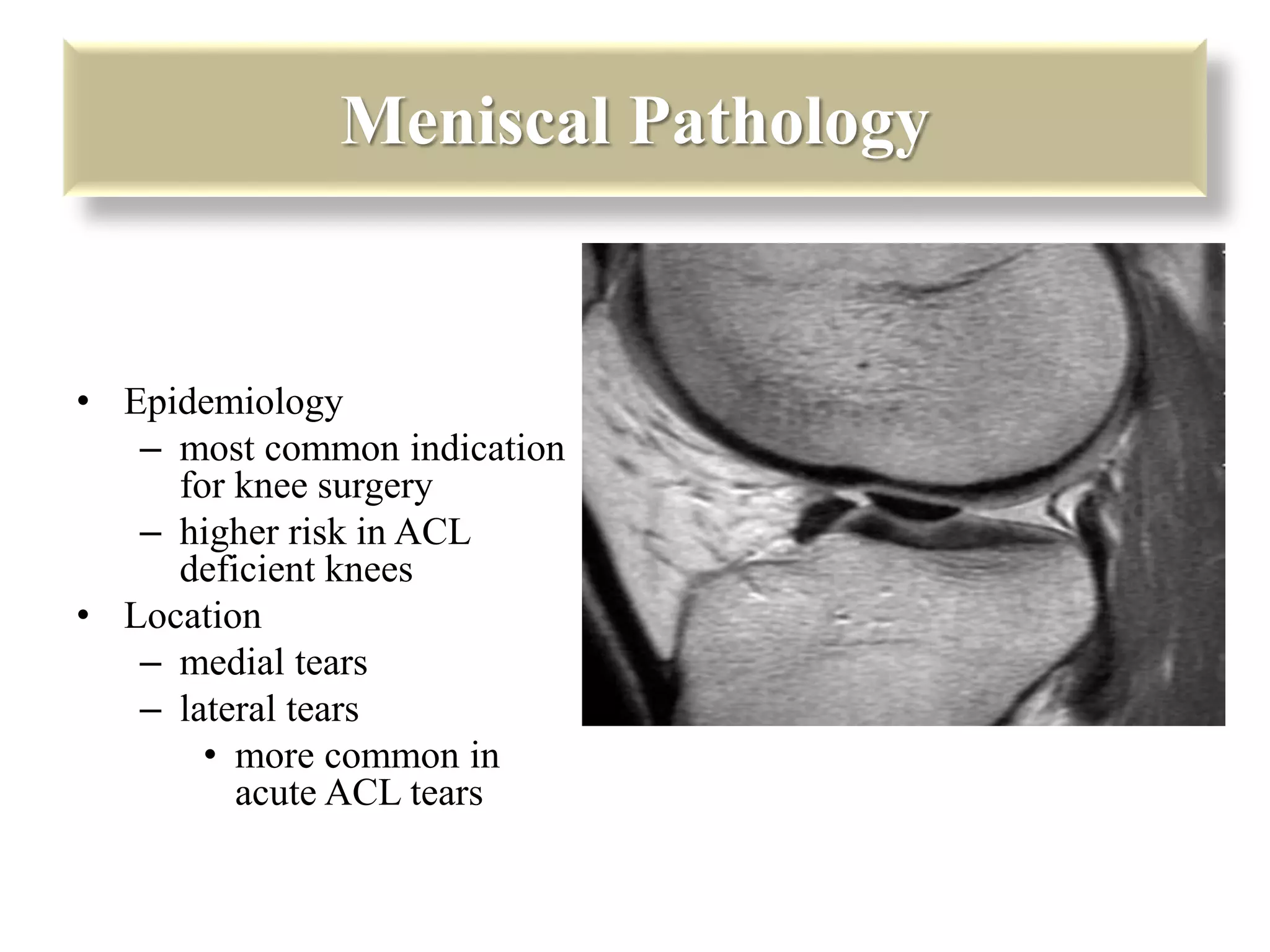 Meniscal injury | PPTX