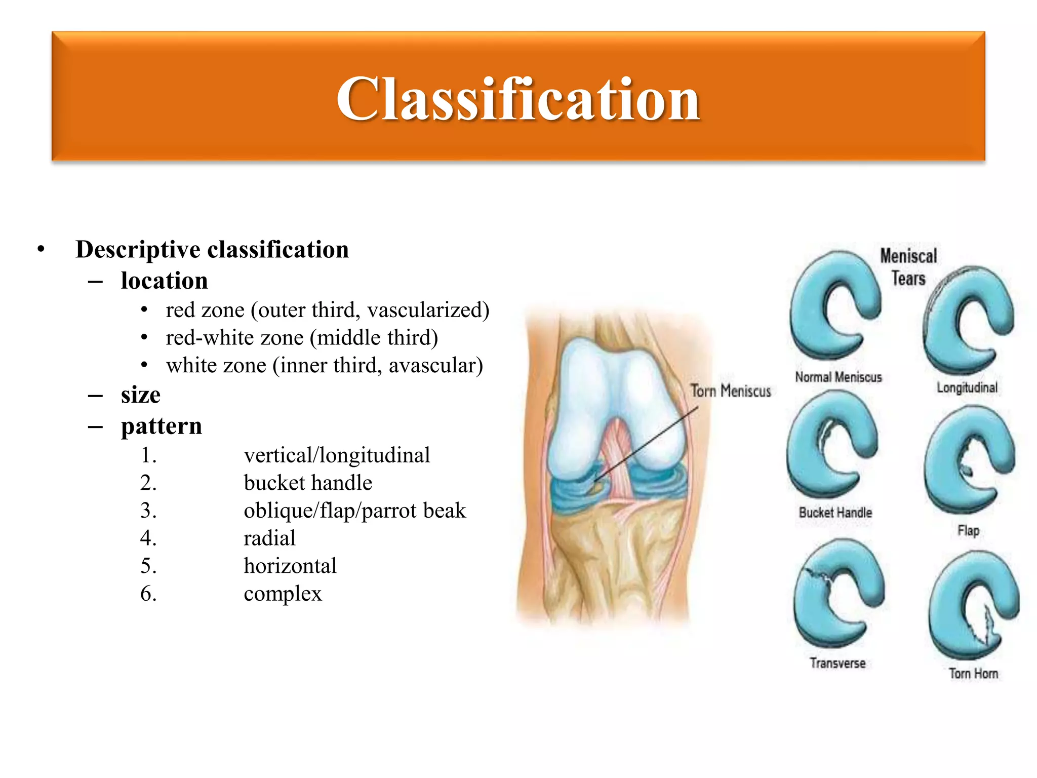 Meniscal injury | PPTX