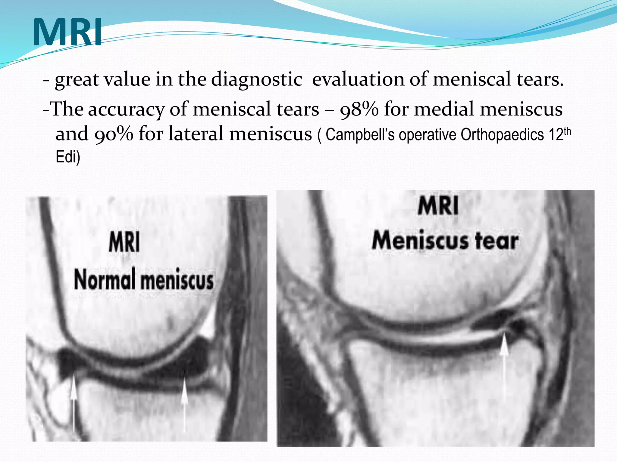 Meniscal injury | PPTX