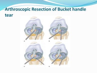 Knee Meniscus Tear Easy Explained OrthoFixar 2023, 58% OFF
