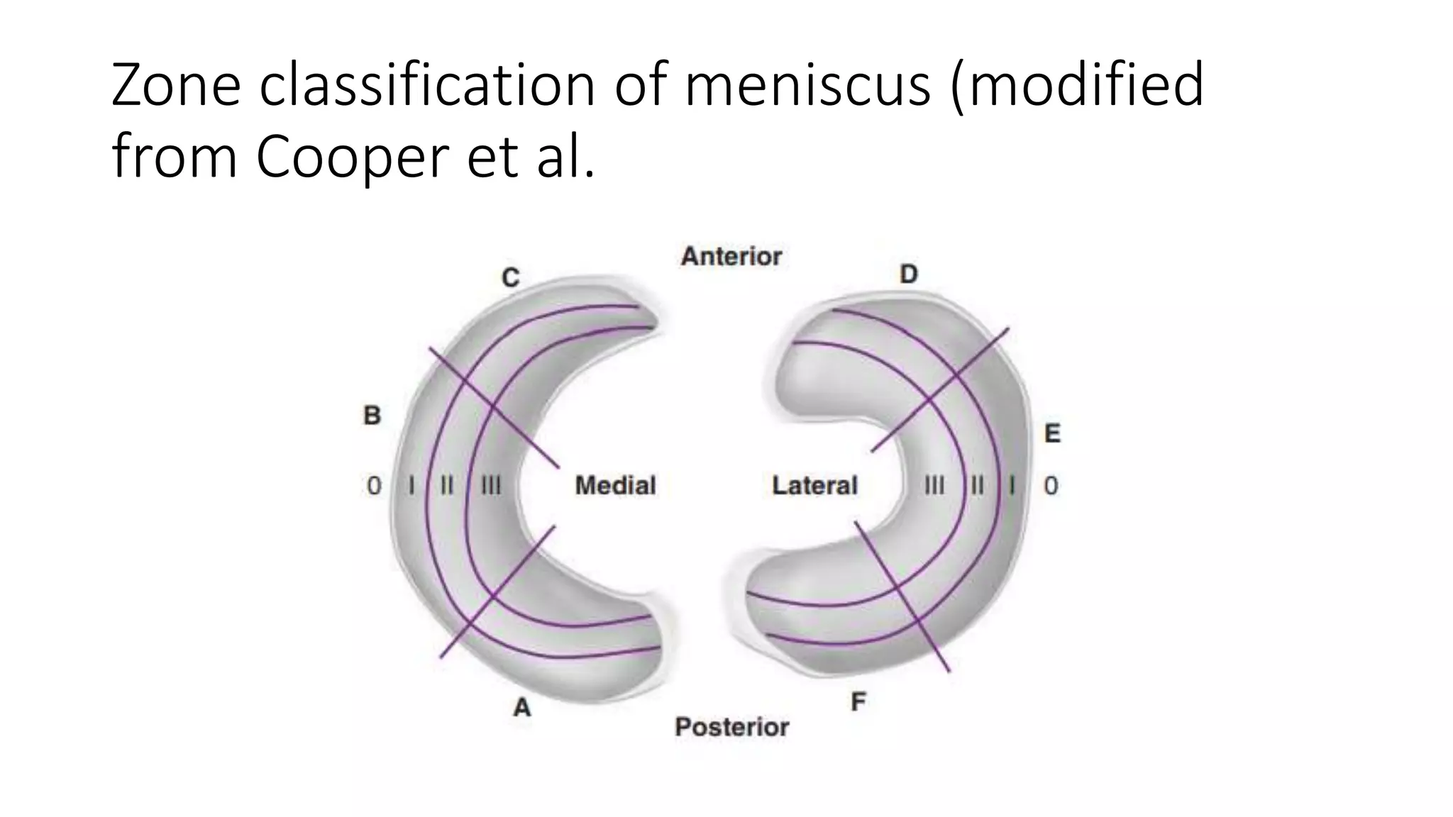 Meniscal injury | PPTX