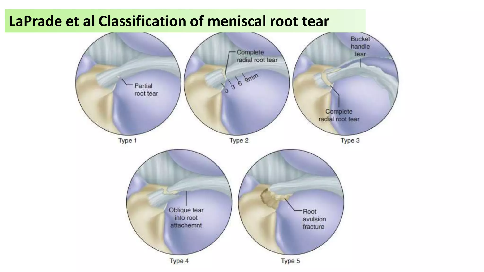 Meniscal injury | PPTX