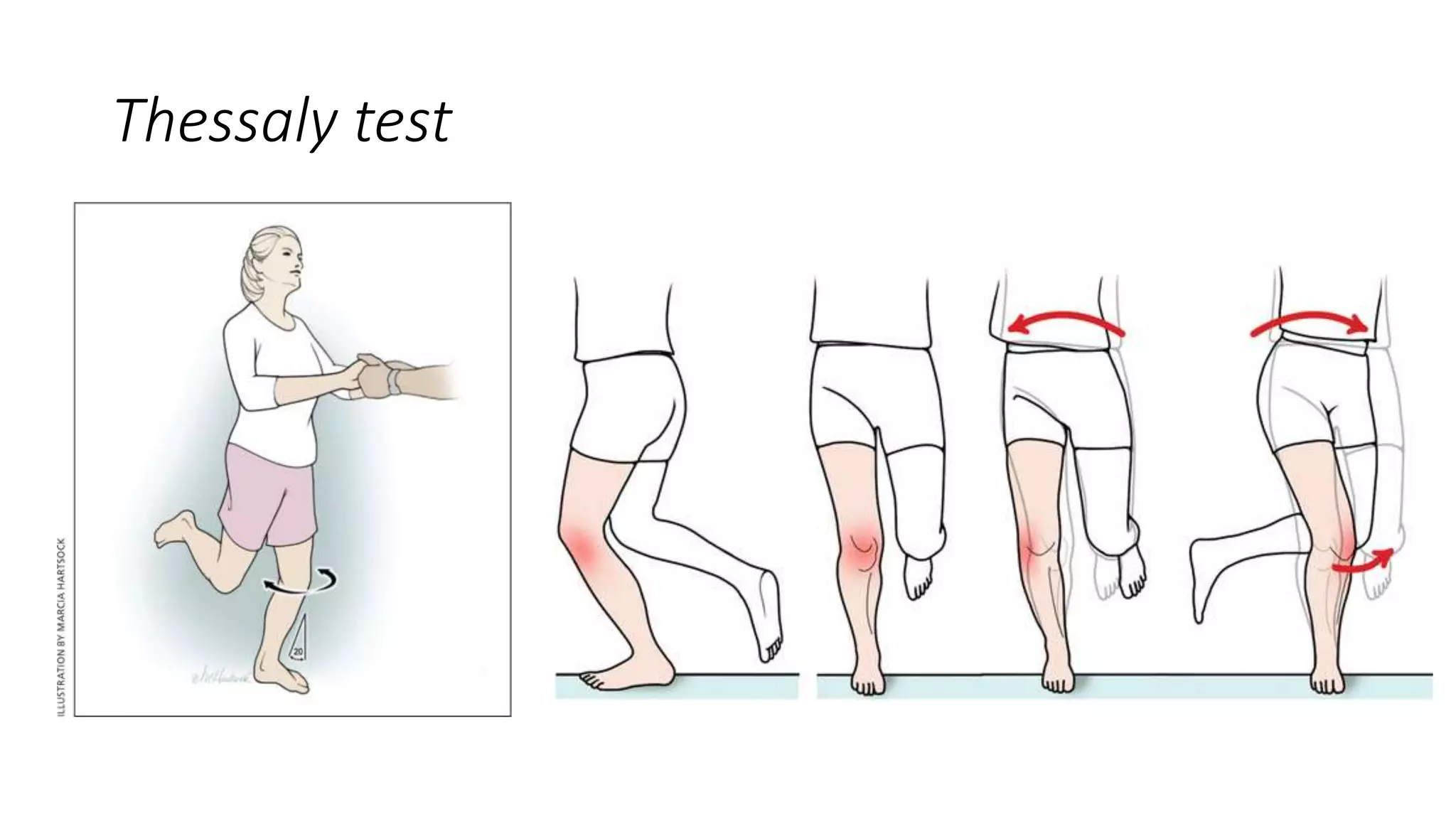 Meniscal injury | PPTX