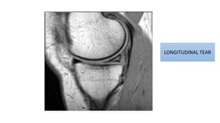 Meniscal injury | PPT
