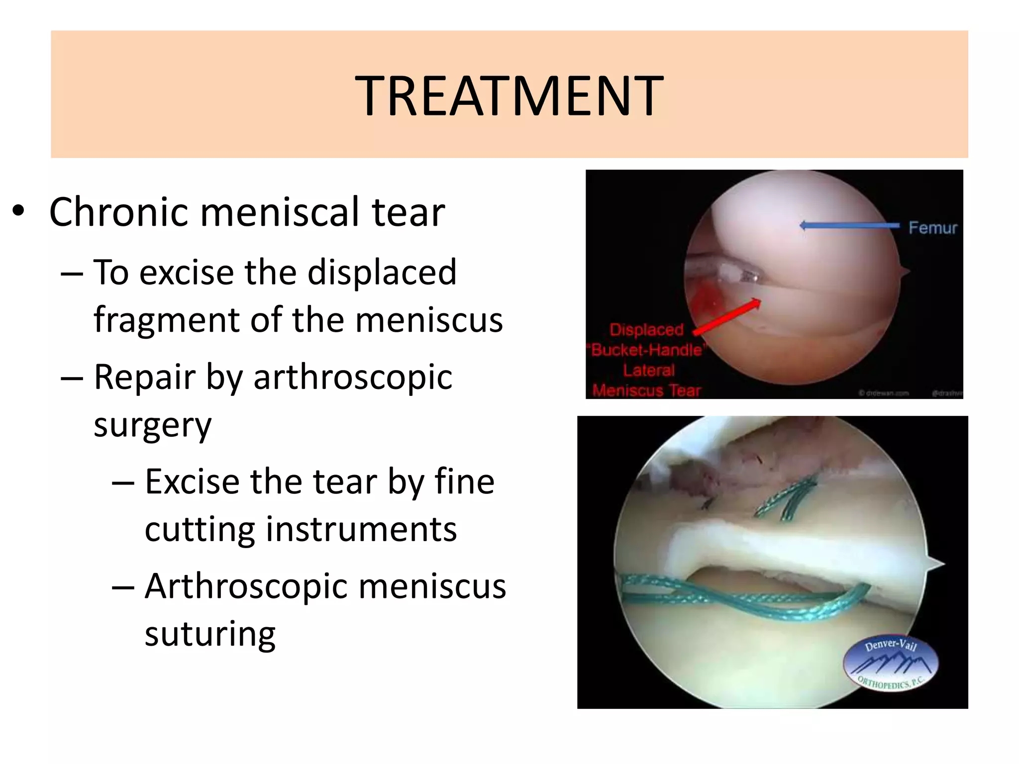 Meniscal injury | PPTX