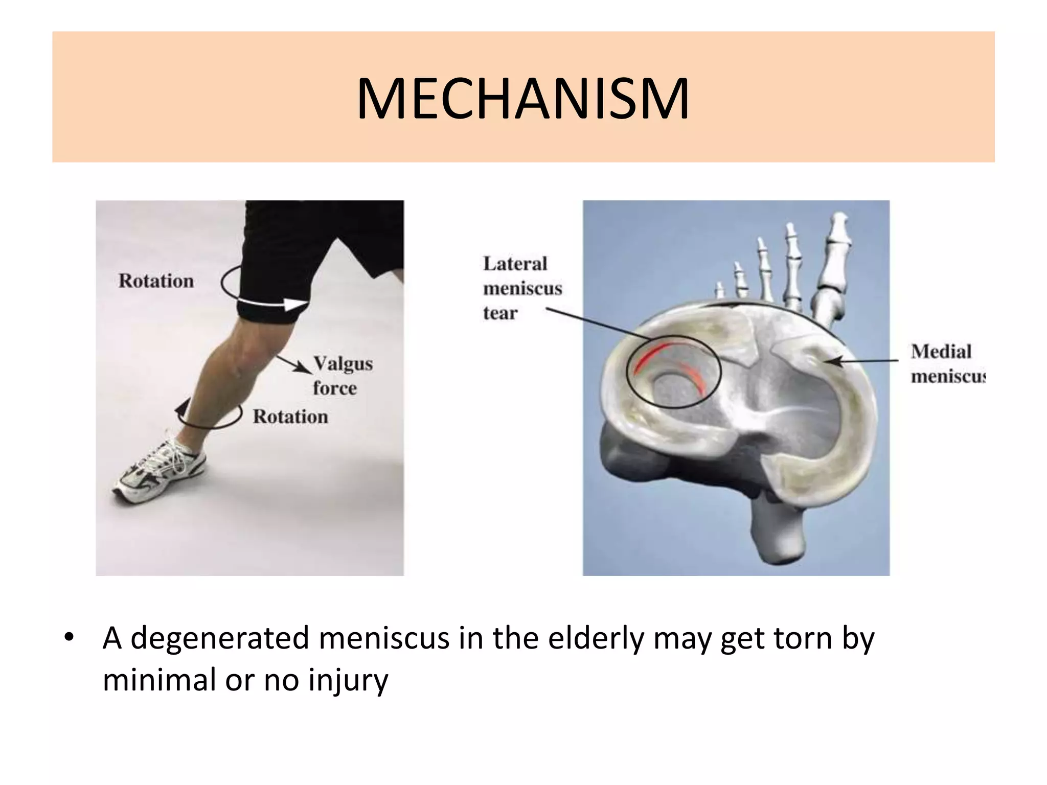 Meniscal injury | PPTX