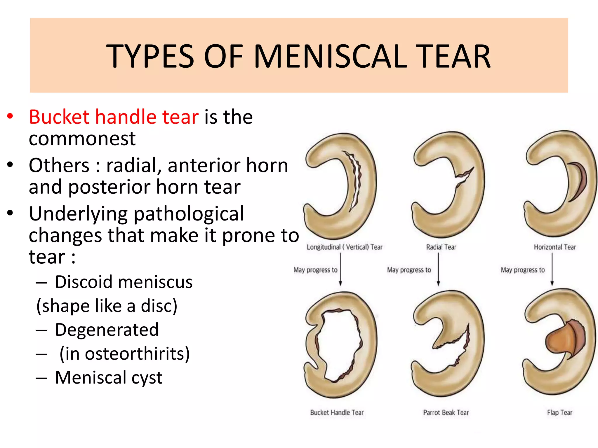 Meniscal injury | PPTX