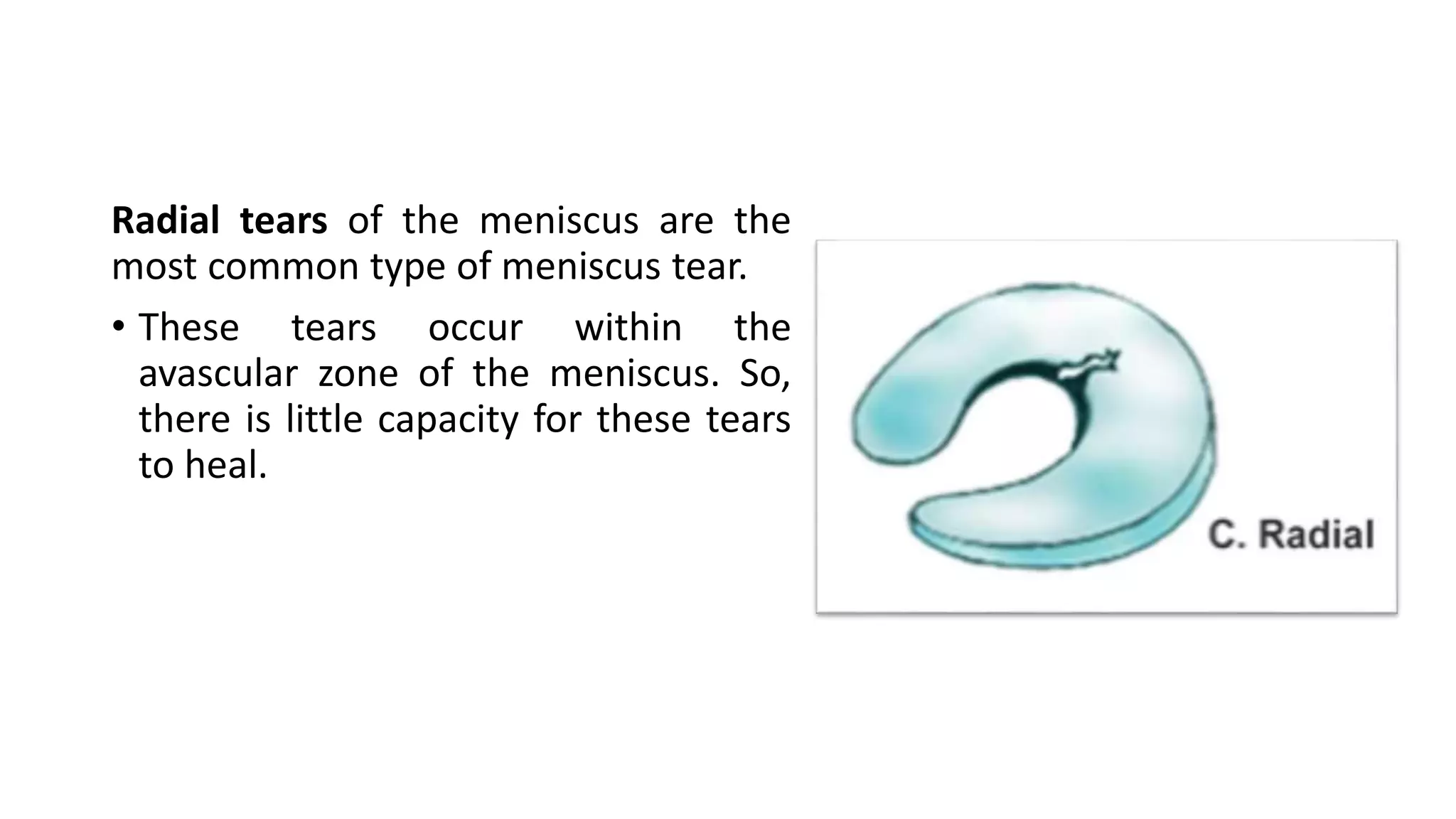 Meniscal injuries and physiotherapy management | PPTX