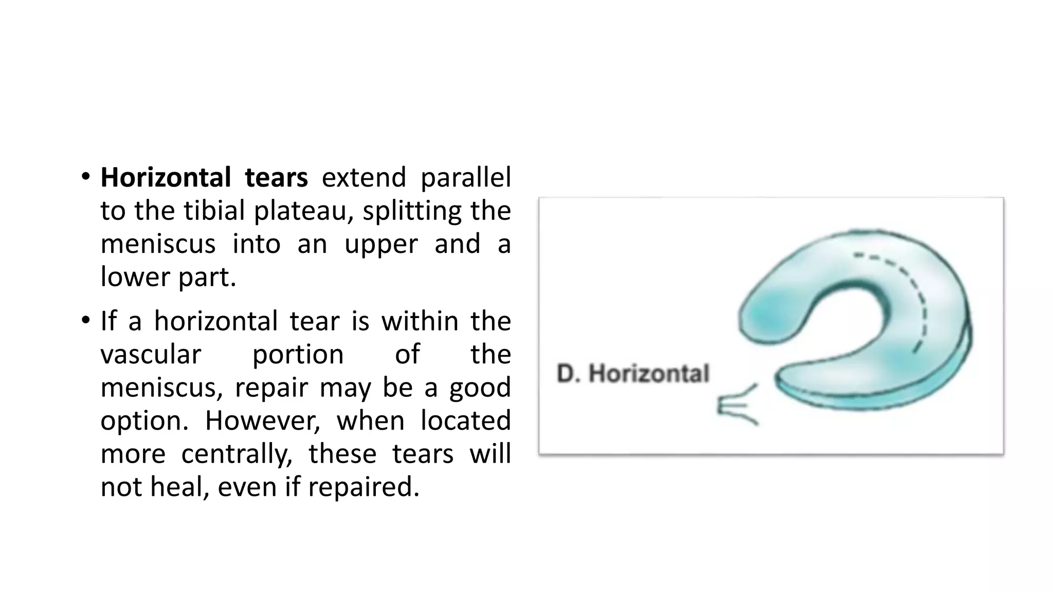 Meniscal injuries and physiotherapy management | PPTX