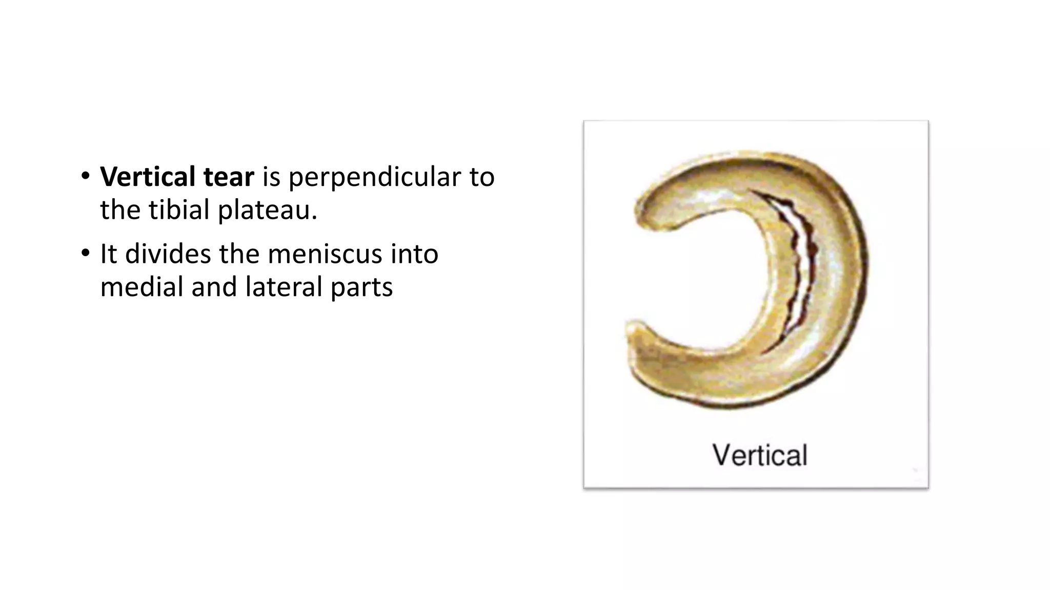 Meniscal injuries and physiotherapy management | PPTX