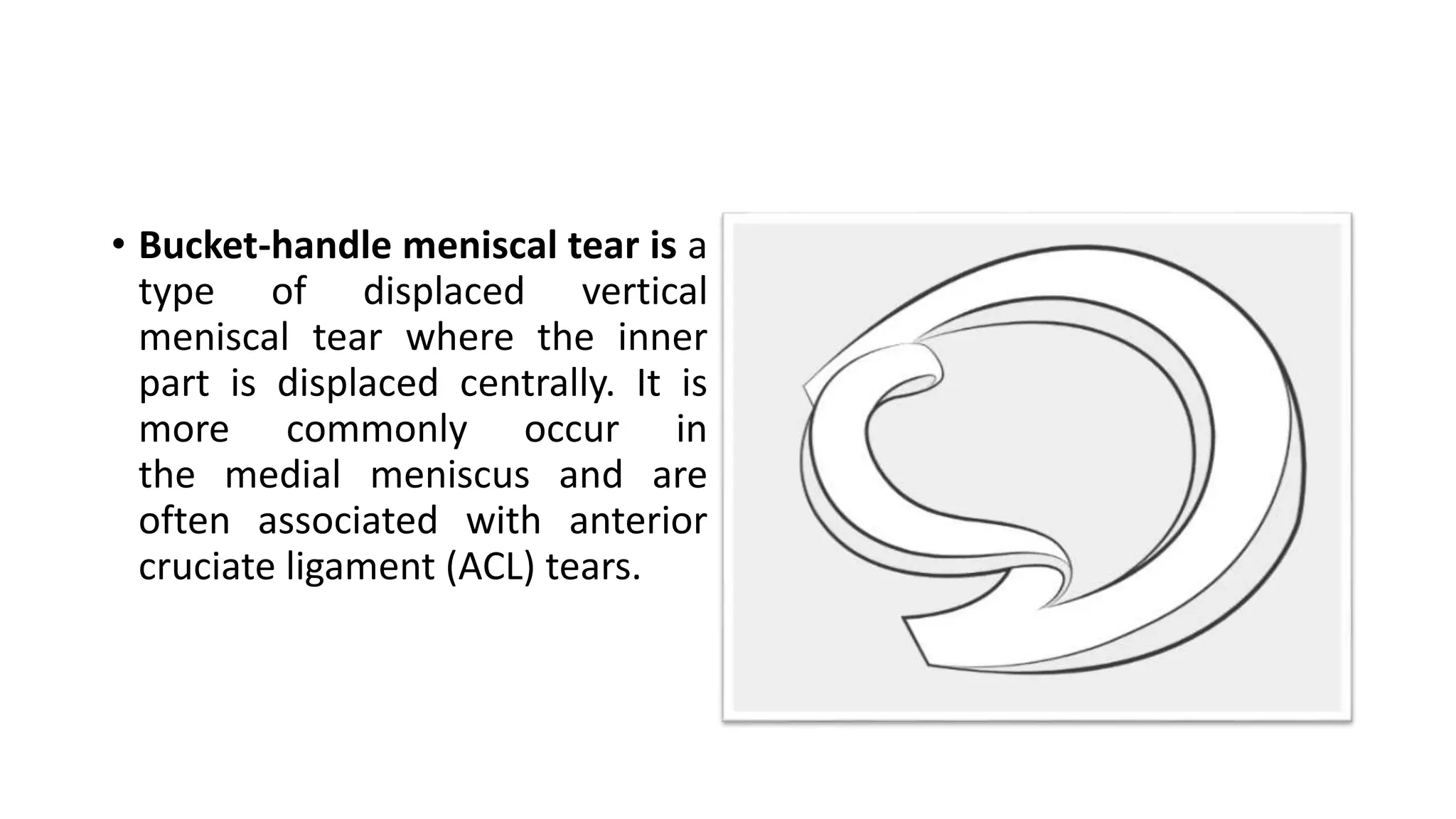 Meniscal injuries and physiotherapy management | PPTX