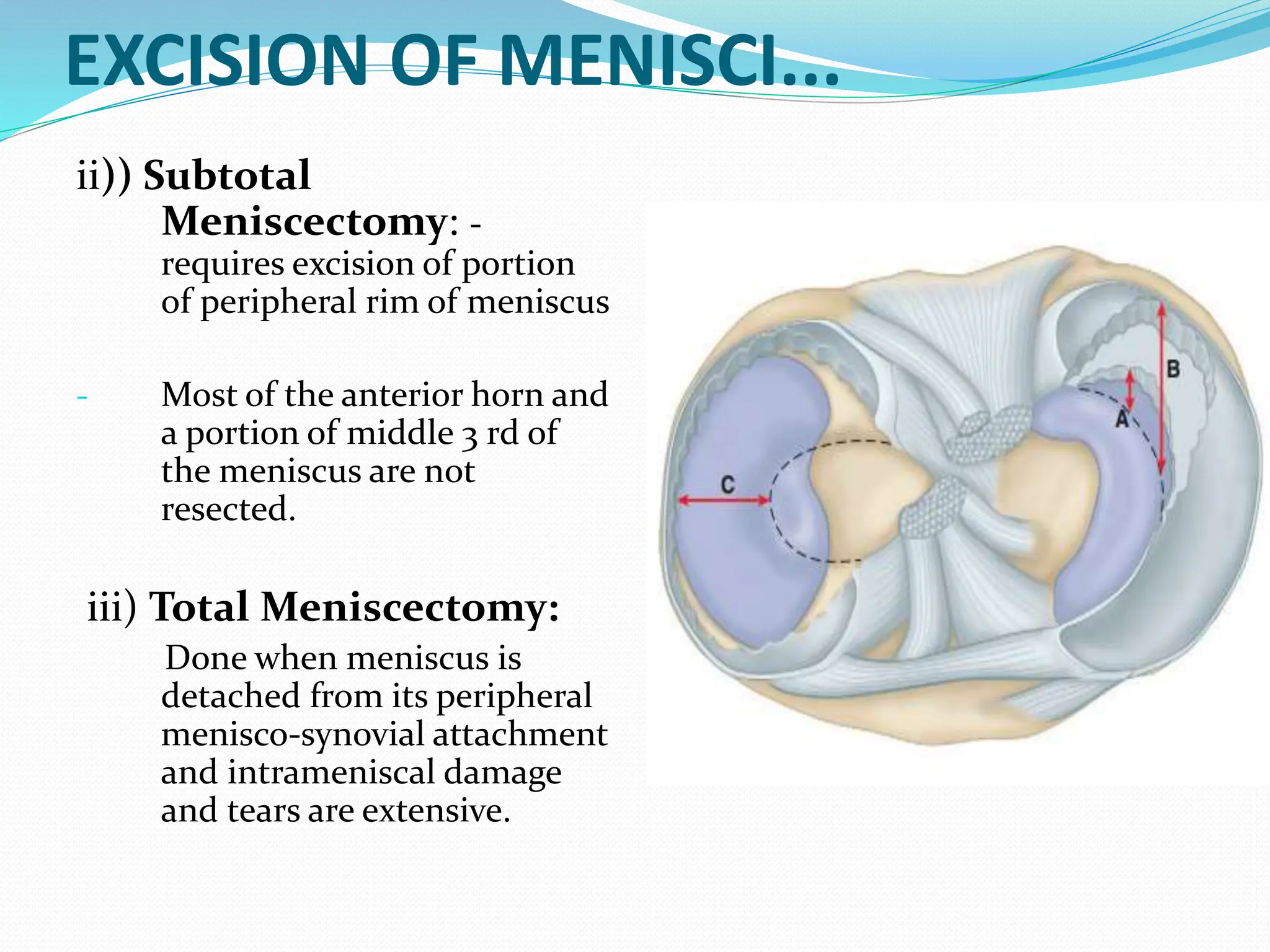 Meniscal Injury.pptx. . | PPTX