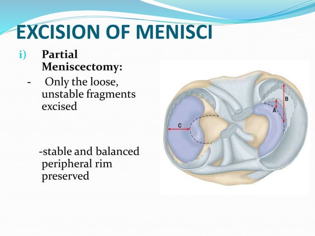 Meniscal Injury.pptx. . | PPT