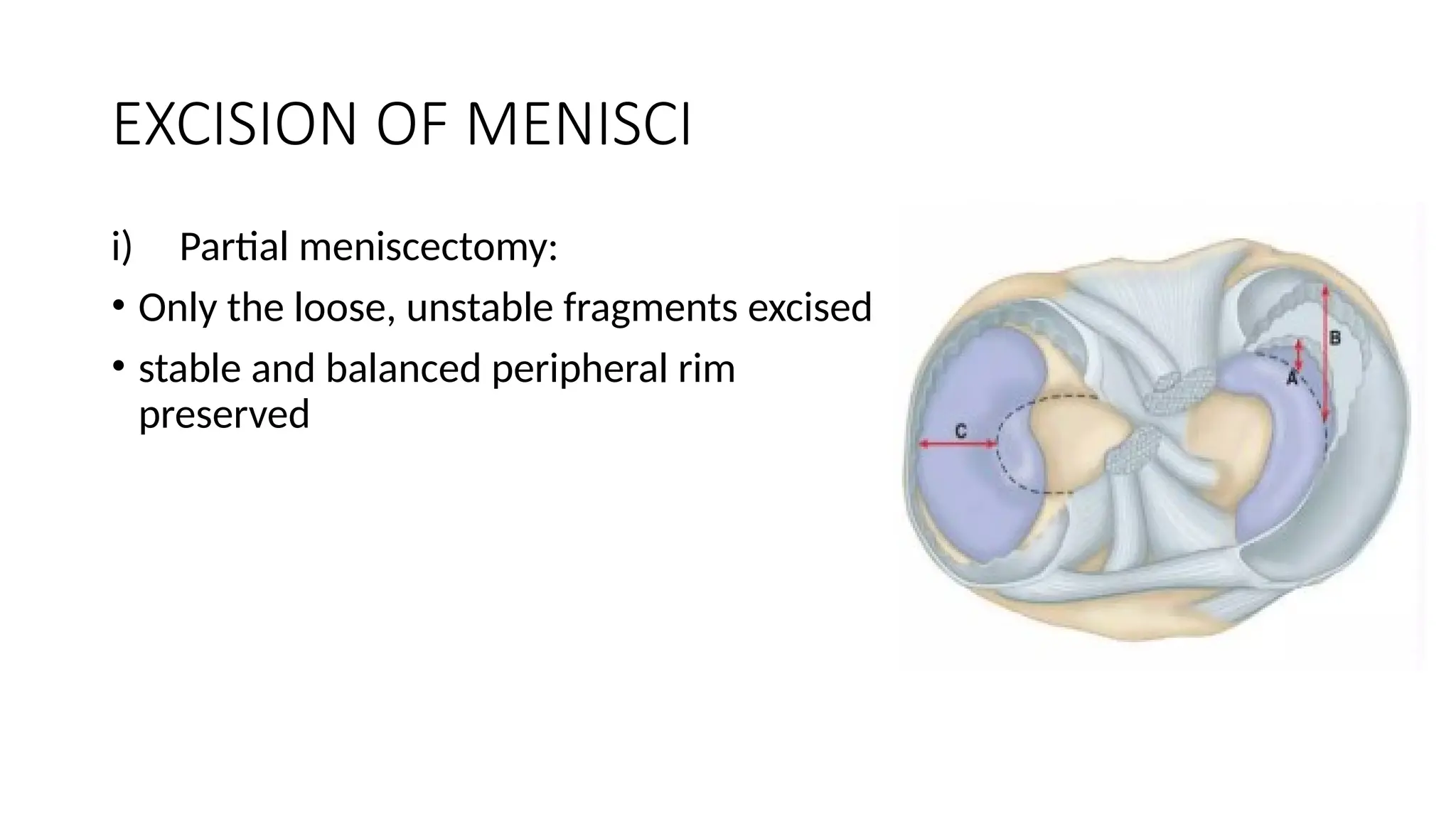 Knee meniscal injury and management.pptx