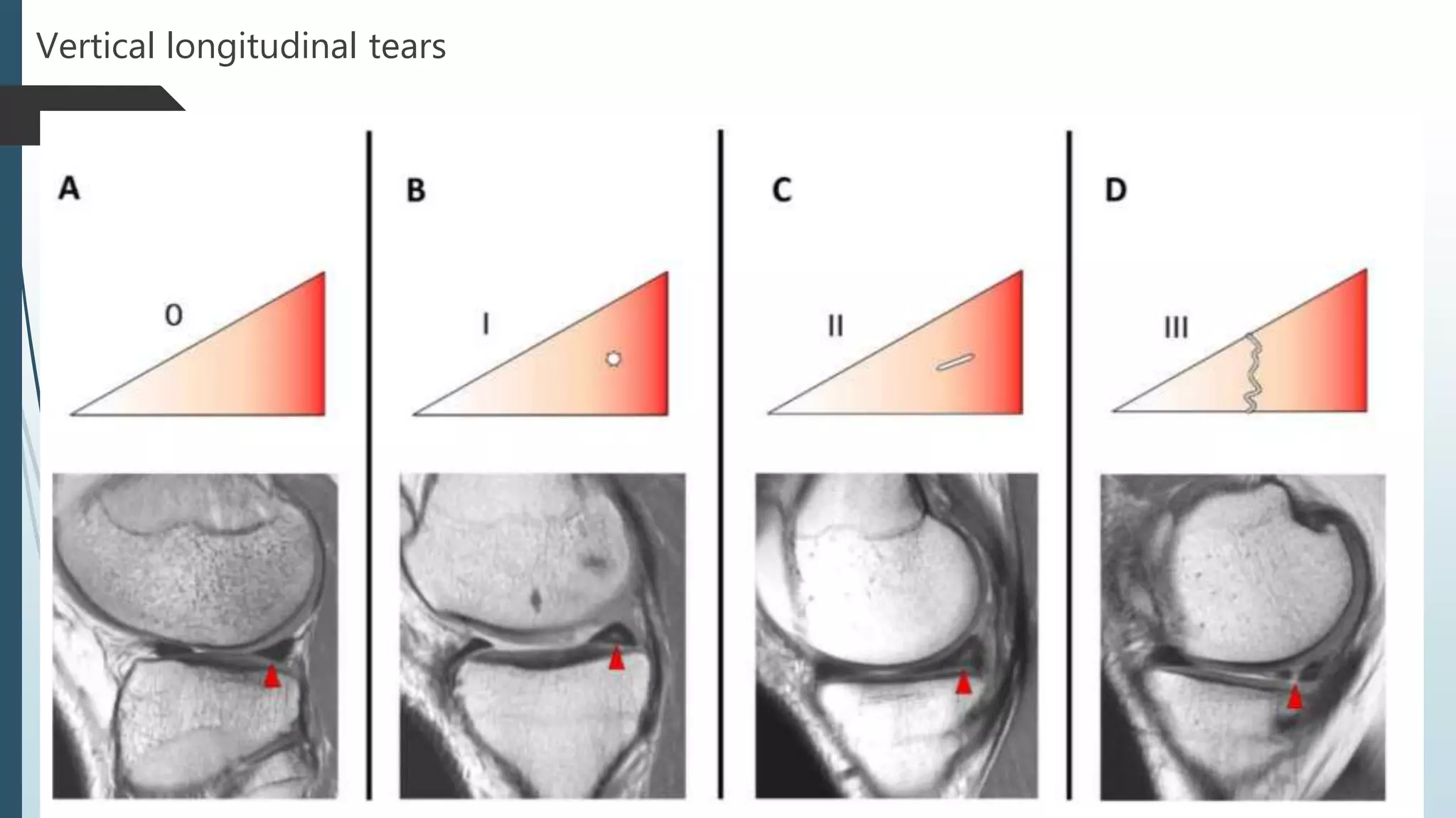 Meniscal injury | PPT
