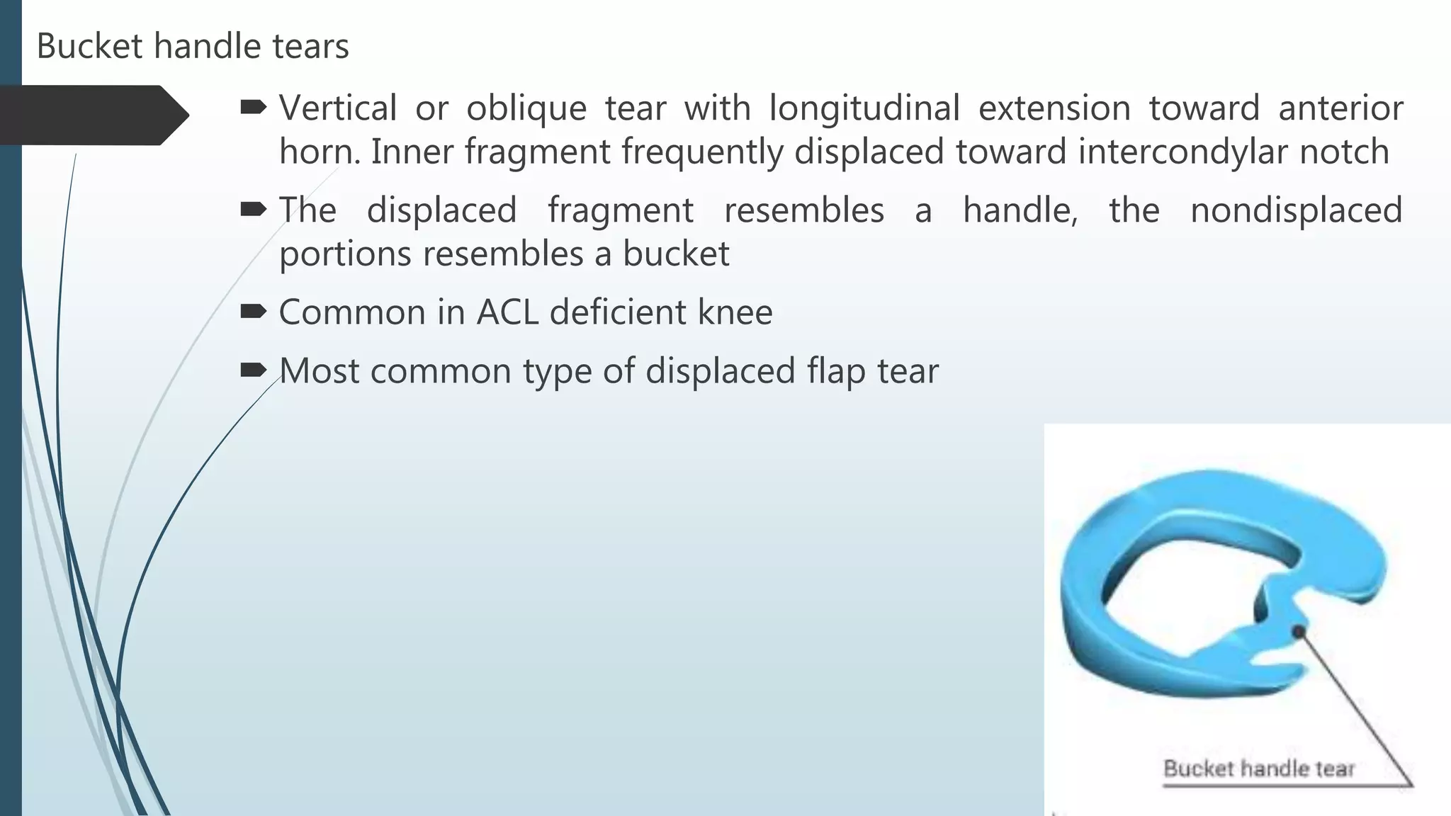 Meniscal injury | PPT