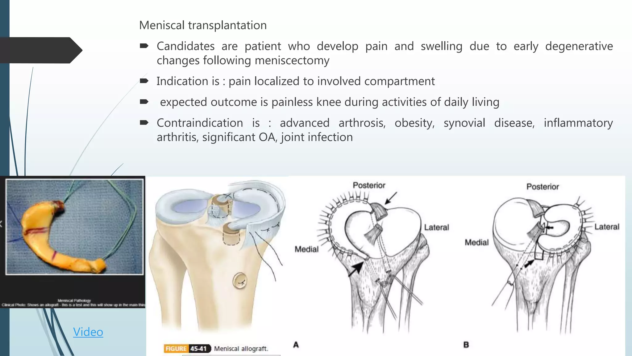 Meniscal injury | PPT