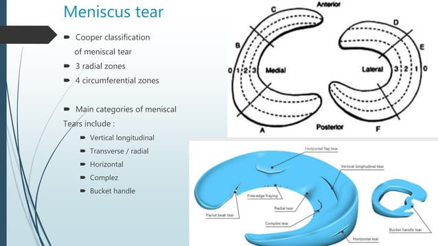Meniscal injury | PPT
