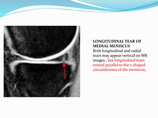 Meniscal pathologies and cartilage injuries | PPTX