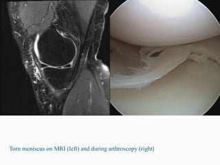 Meniscal pathologies and cartilage injuries | PPTX
