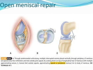 Meniscal pathologies and cartilage injuries | PPTX