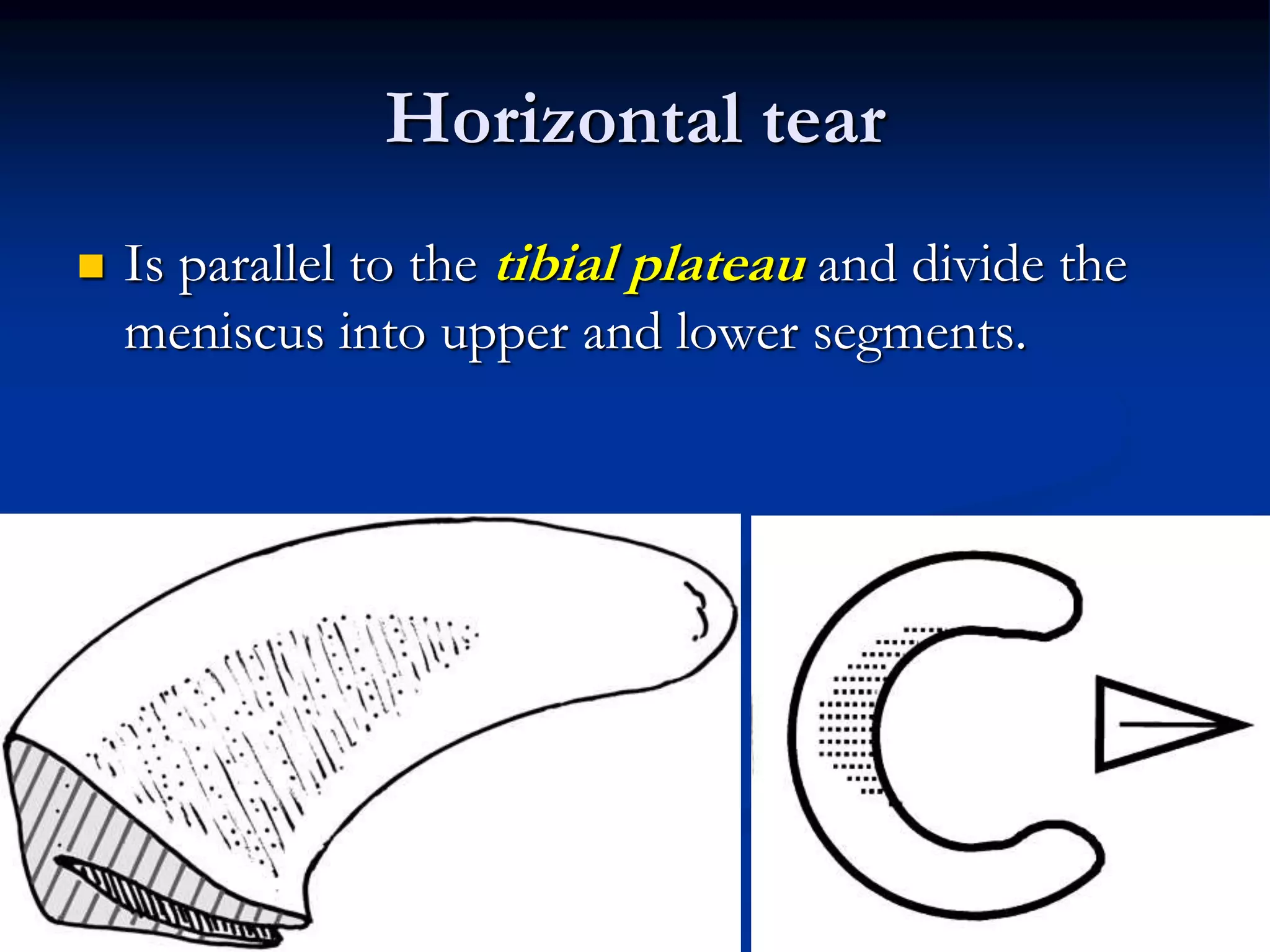 Meniscal pathology | PPT