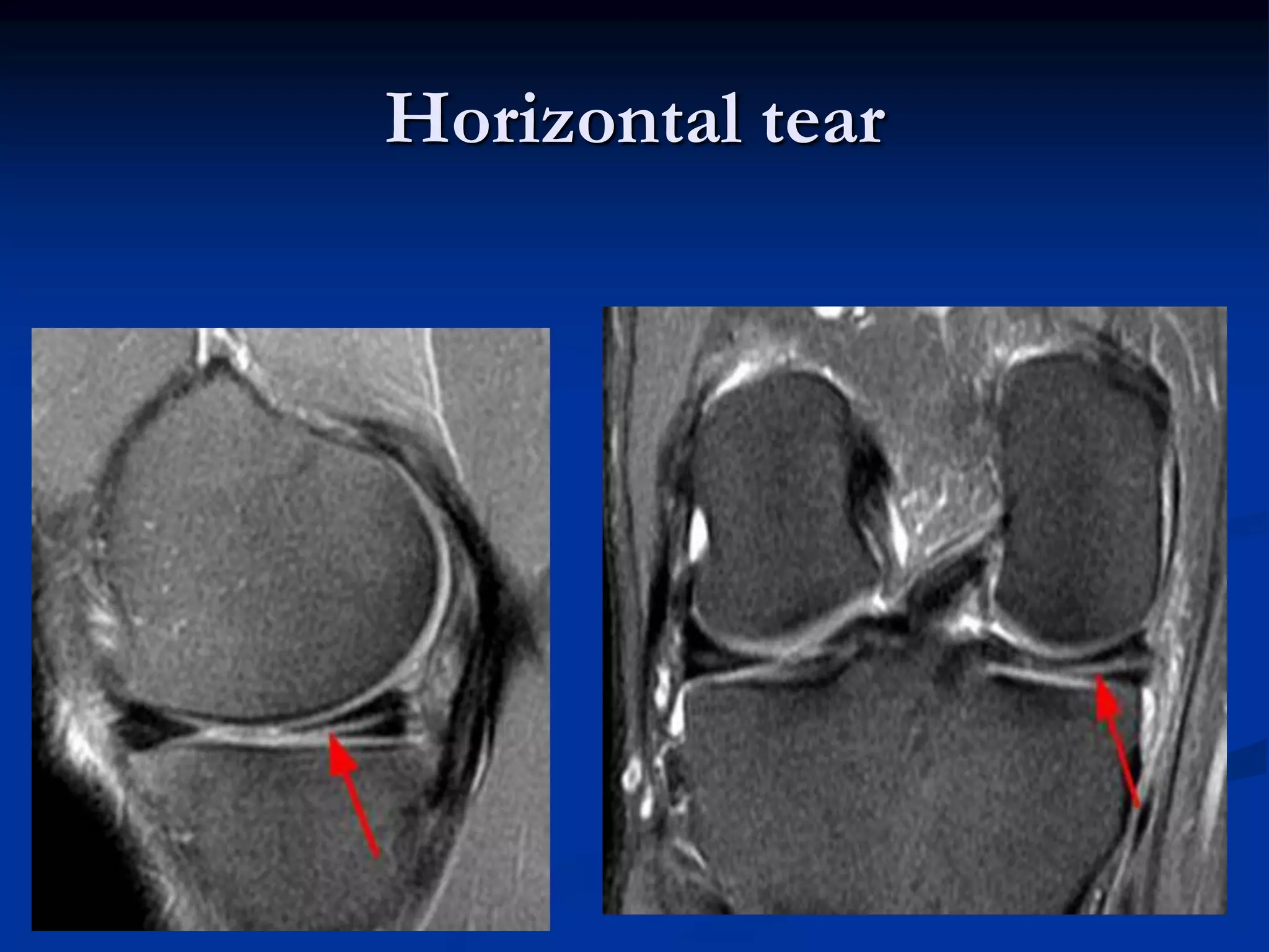 Meniscal pathology | PPT