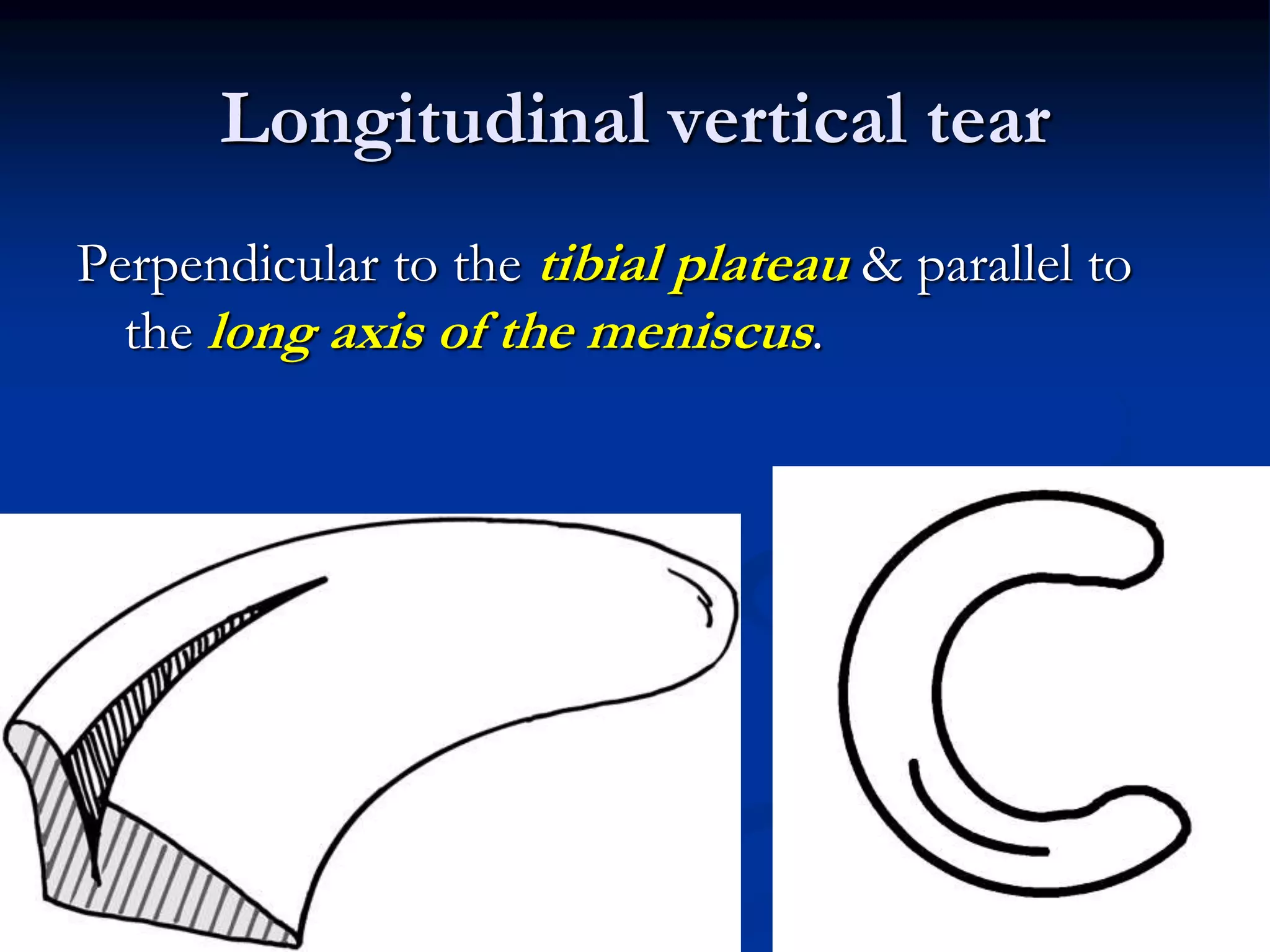 Meniscal pathology | PPT | Death, Injury, or Military Conflict ...