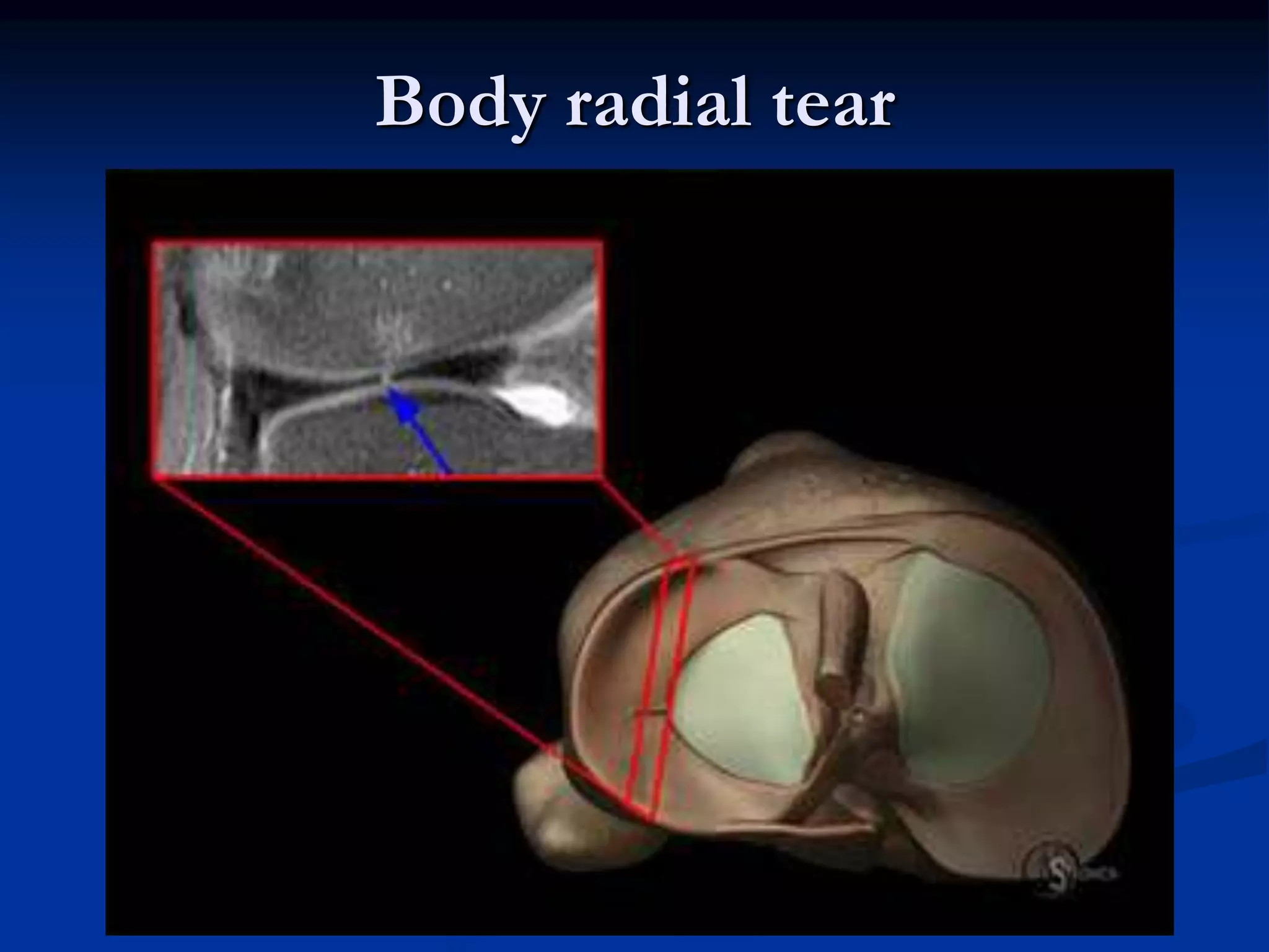 Meniscal pathology | PPT | Death, Injury, or Military Conflict ...