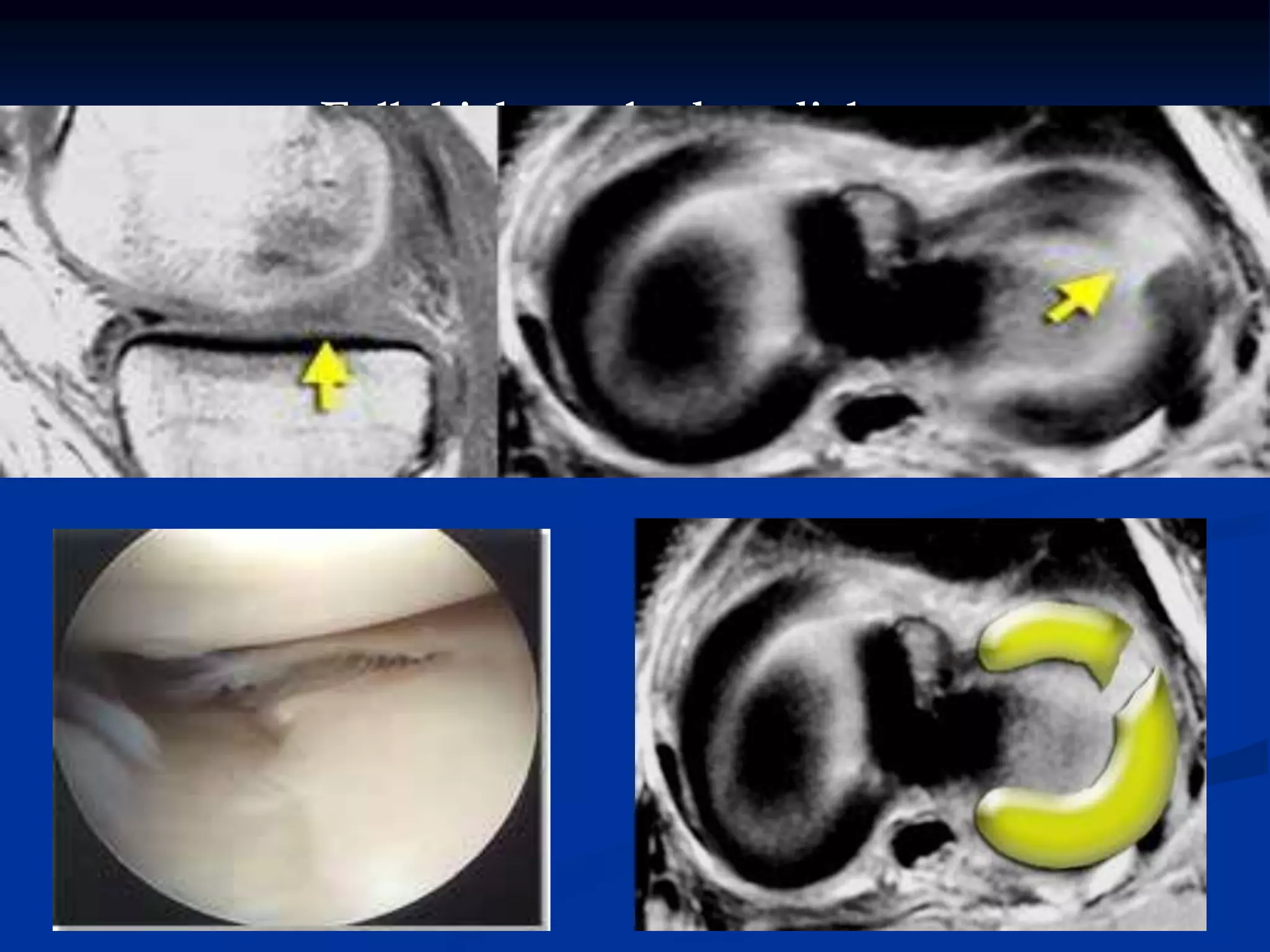 Meniscal pathology | PPT | Death, Injury, or Military Conflict ...
