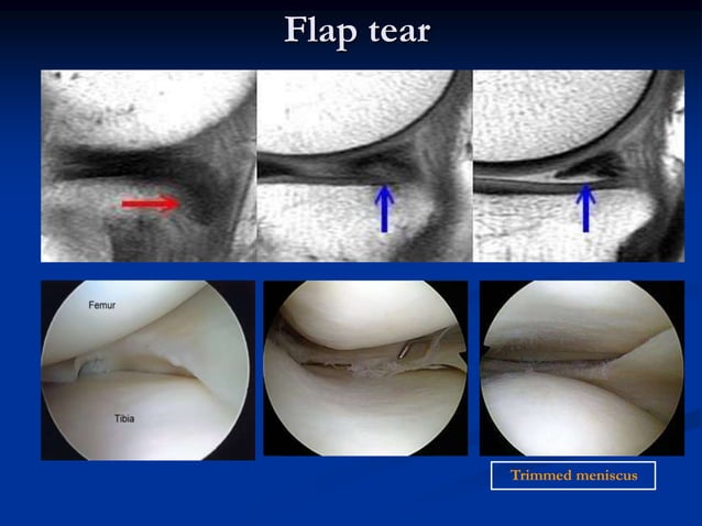 Meniscal pathology | PPT | Death, Injury, or Military Conflict ...