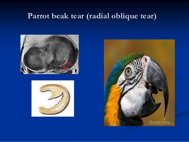 Meniscal pathology