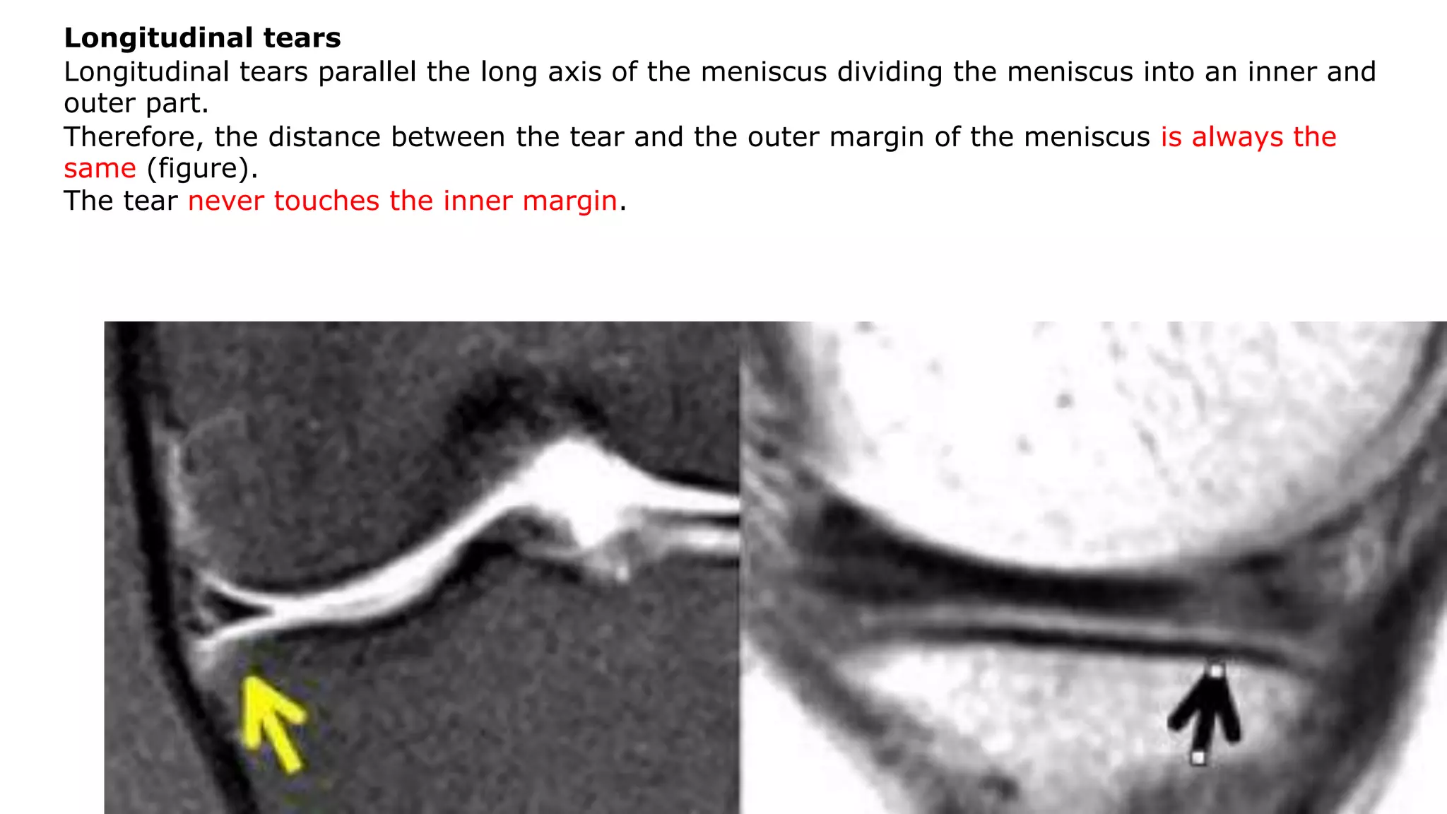 Meniscal pathology radiologyassistant.pptx
