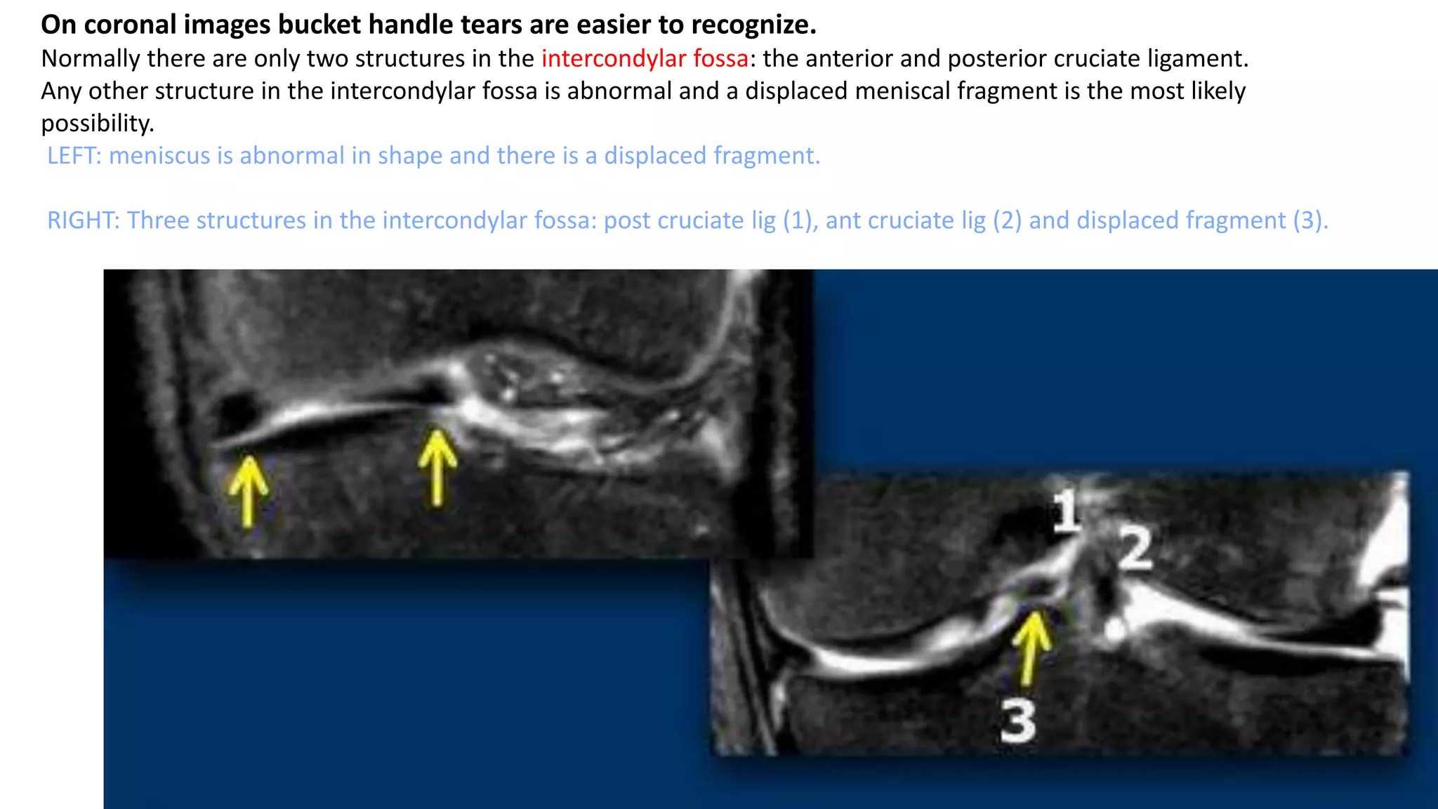 Meniscal pathology radiologyassistant.pptx
