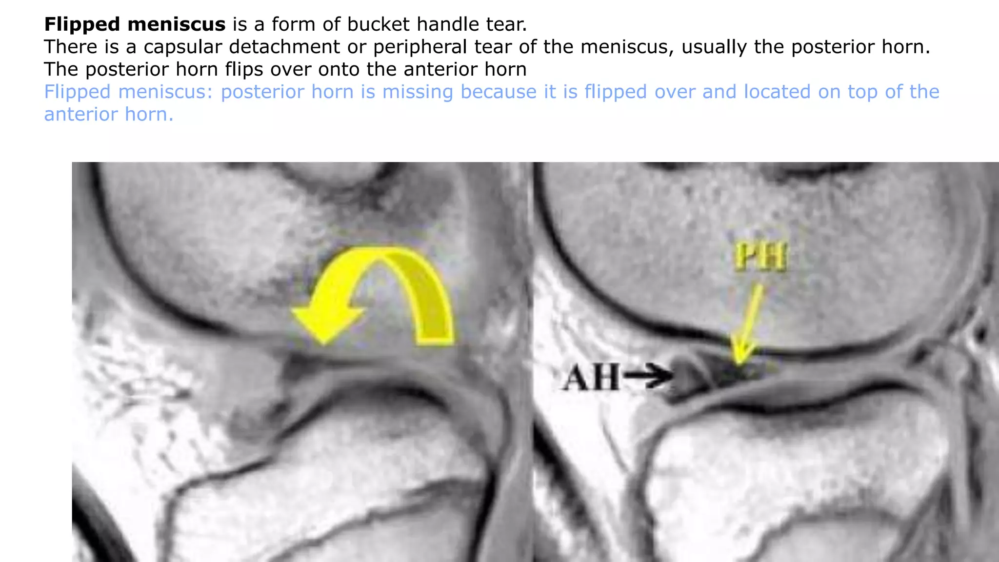 Meniscal pathology radiologyassistant.pptx
