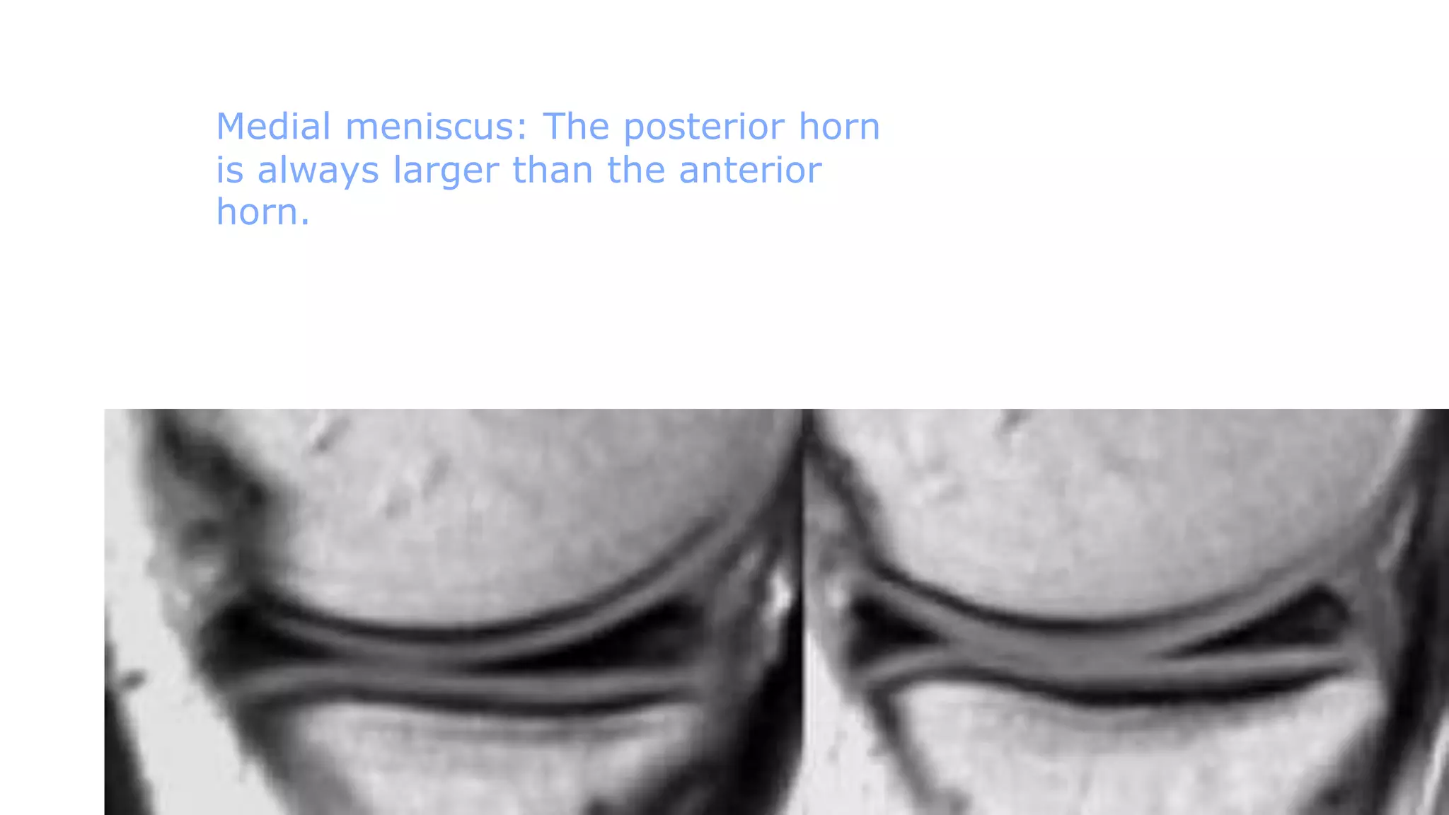Meniscal pathology radiologyassistant.pptx