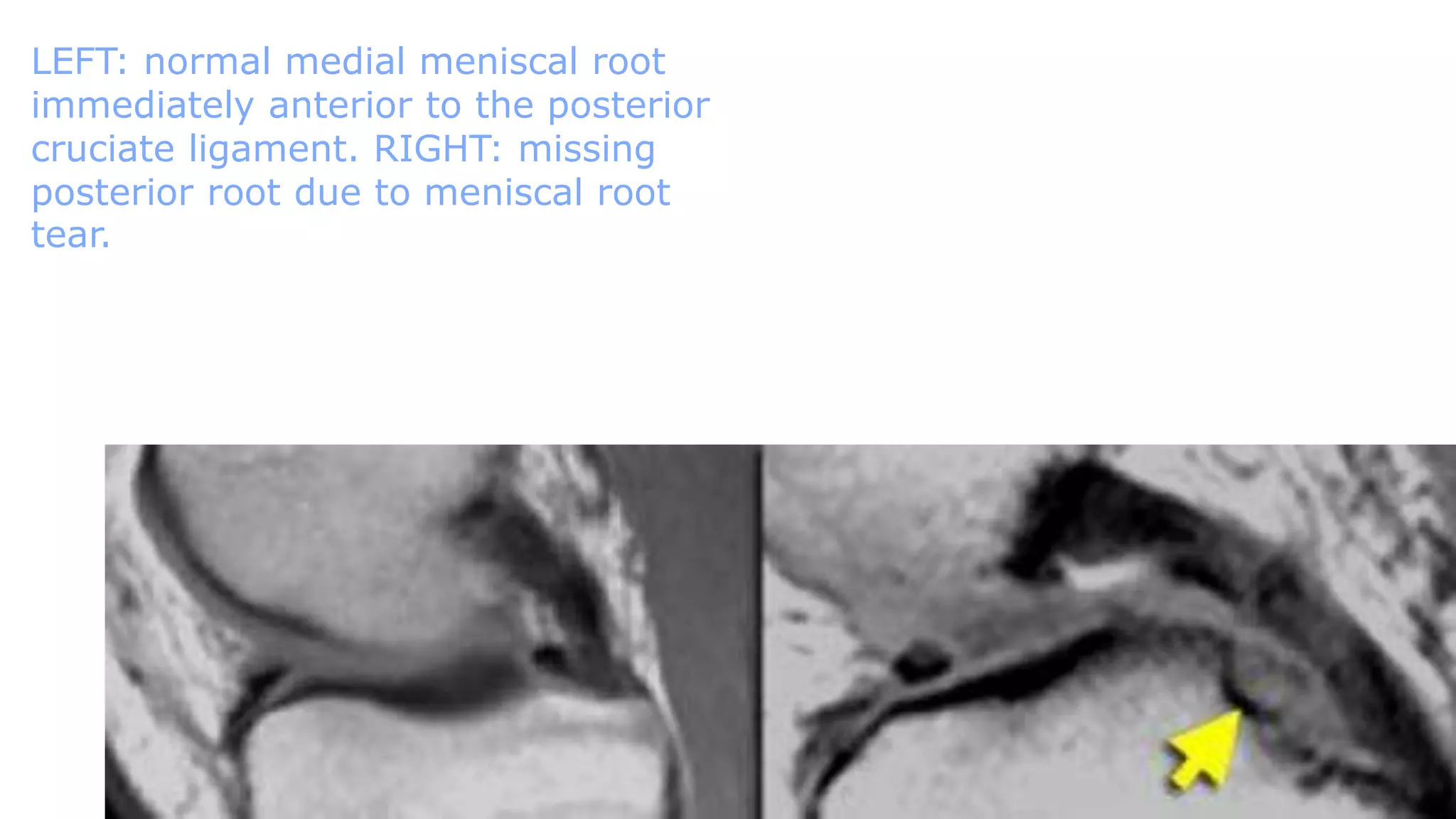 Meniscal pathology radiologyassistant.pptx