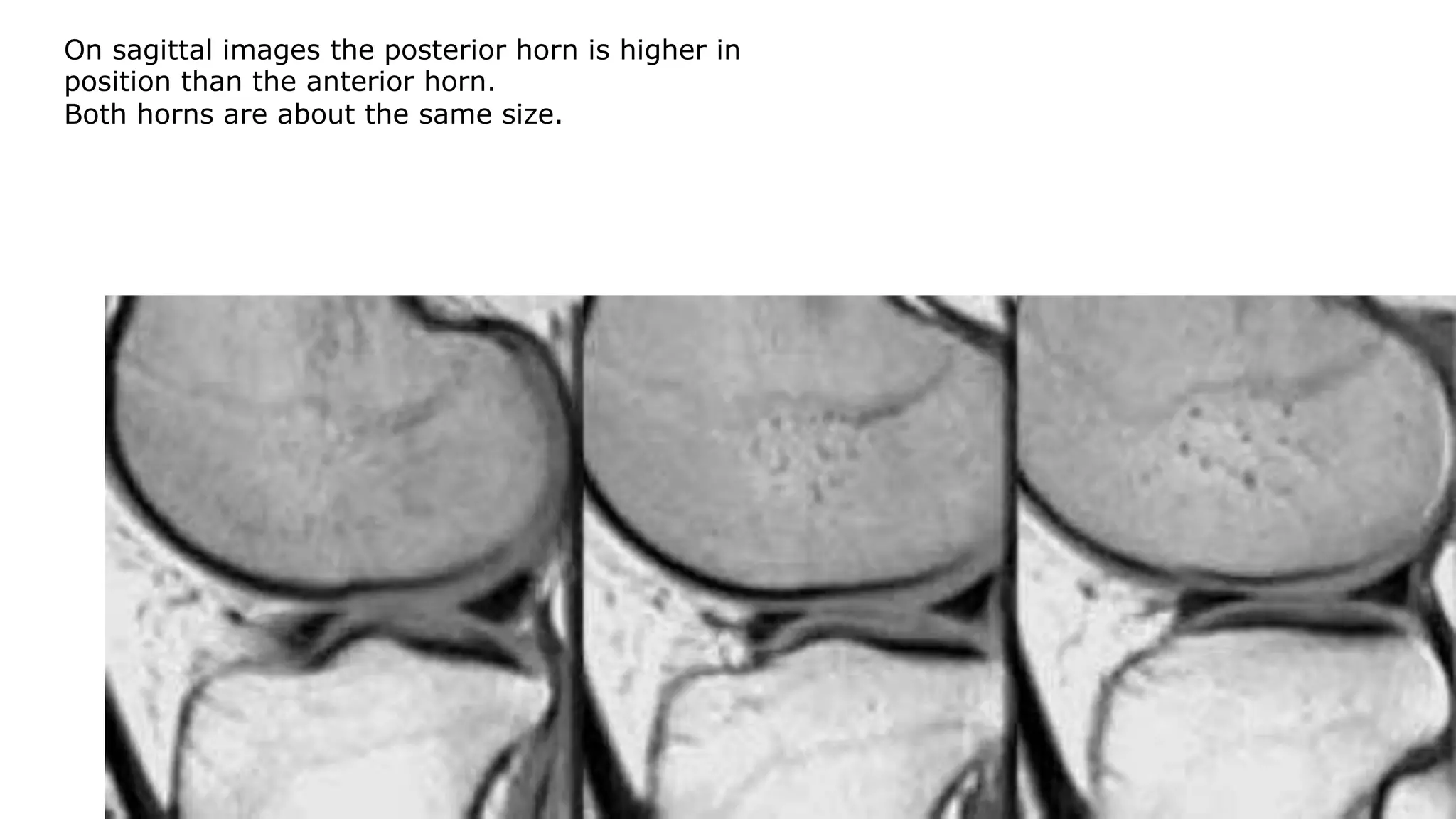 Meniscal pathology radiologyassistant.pptx
