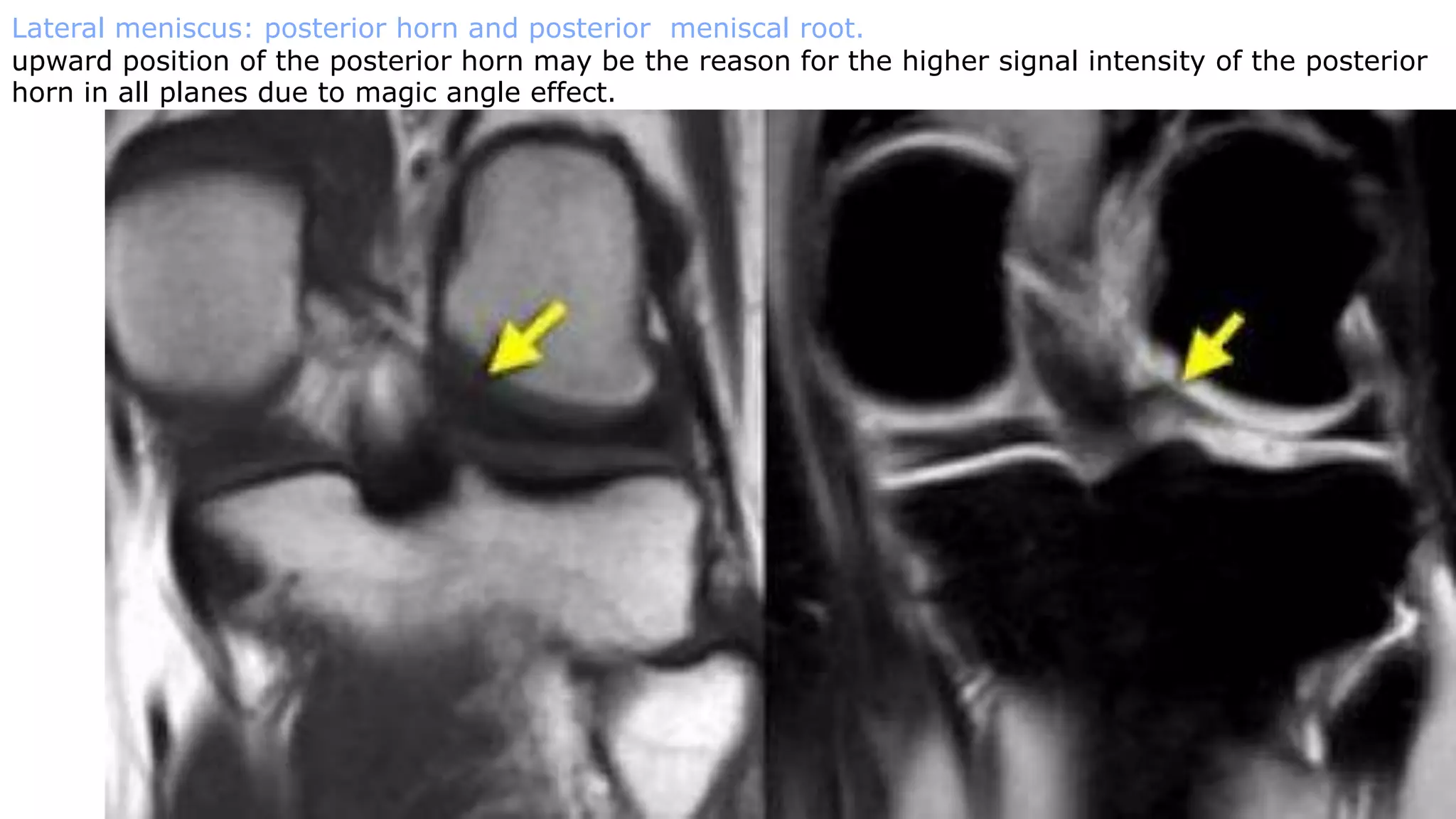 Meniscal pathology radiologyassistant.pptx