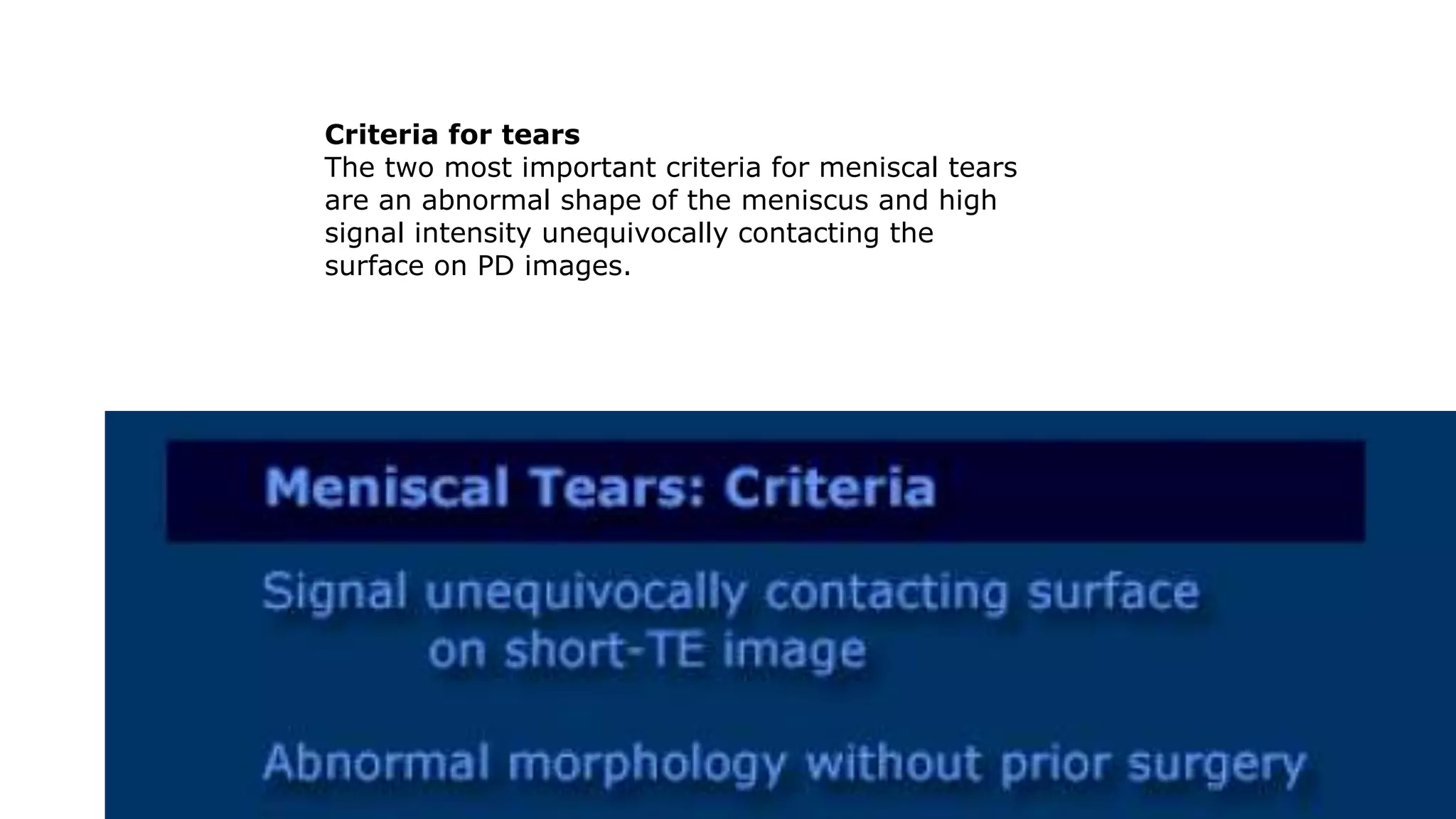 Meniscal pathology radiologyassistant.pptx
