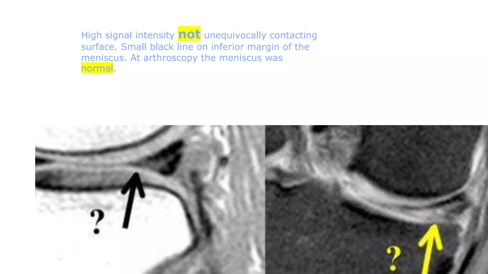Meniscal pathology radiologyassistant.pptx