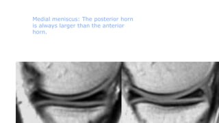 Meniscal pathology radiologyassistant.pptx
