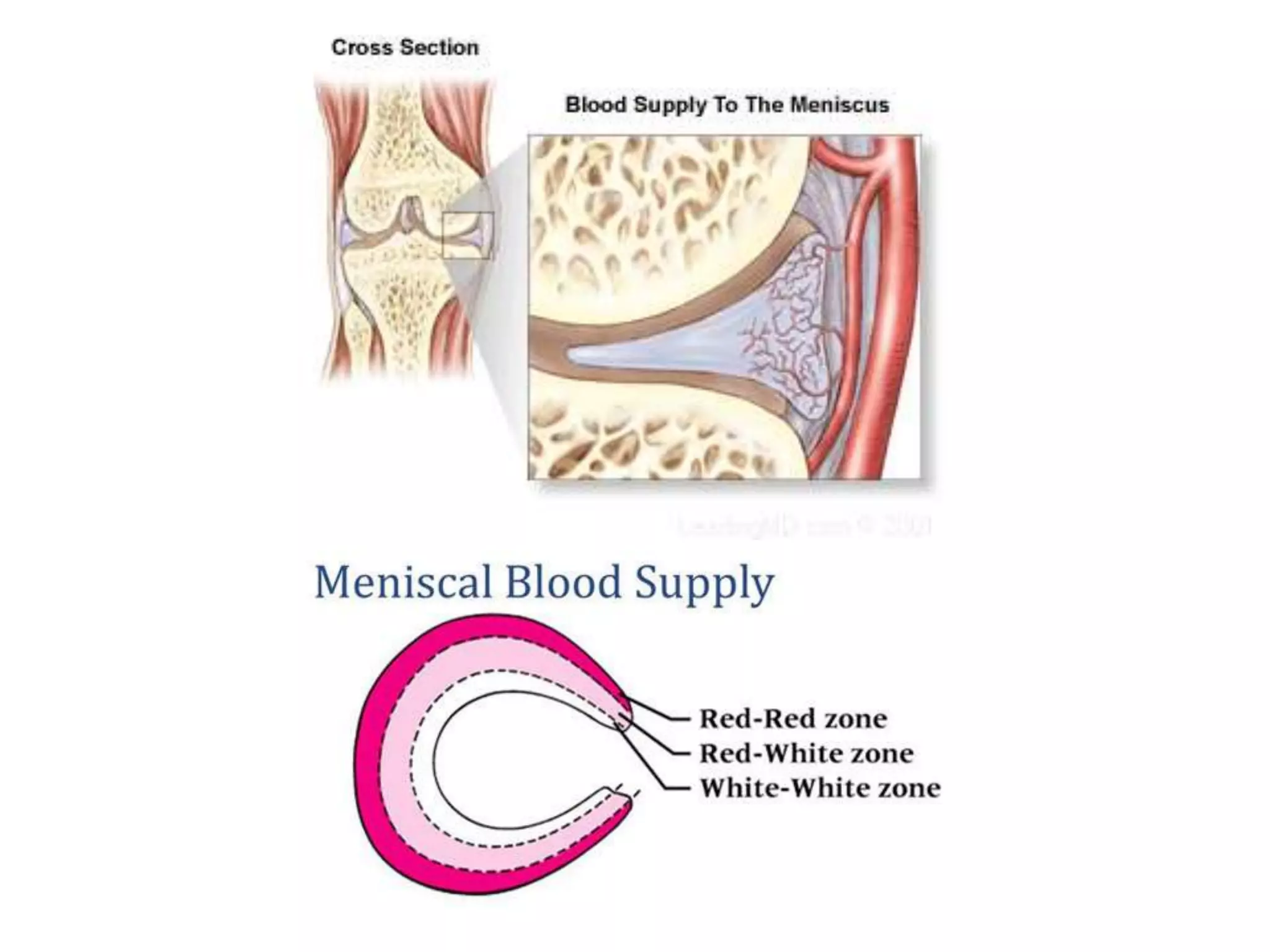 Meniscal tear | PPTX