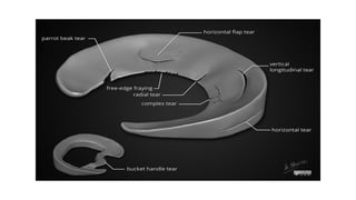 KNEE MENISCAL TEARS AND INJURIES TRATMENT.pptx