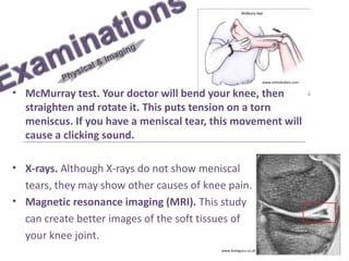 Meniscal tears pp Anndee Neuman | PPT