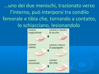 Menisco | PPT
